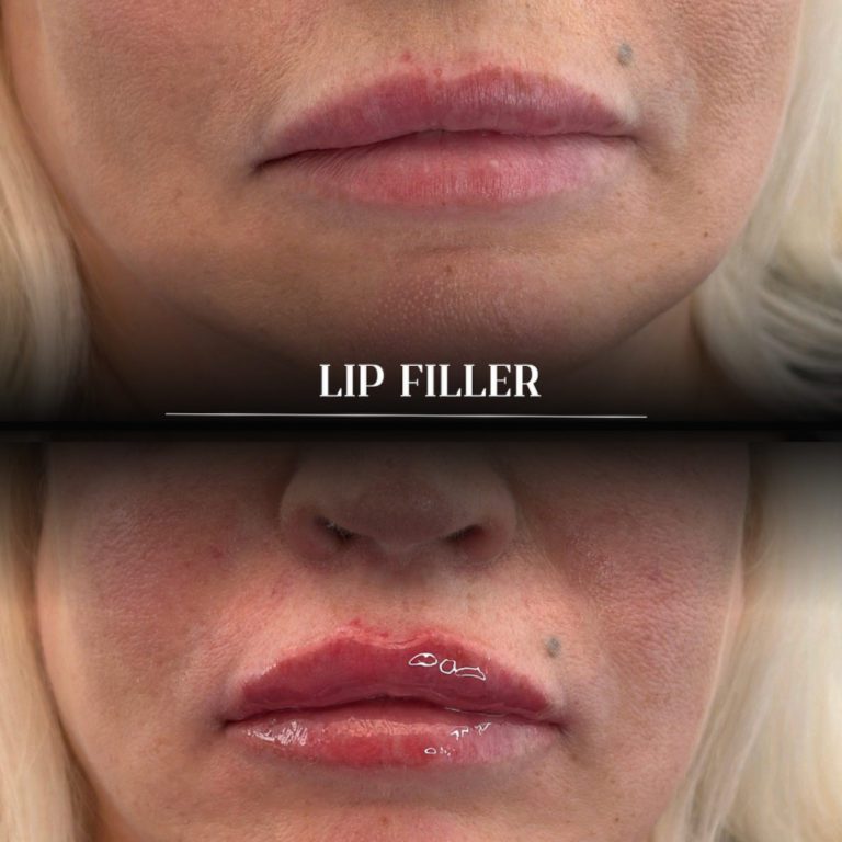 Lip Filler Fuller, Defined Lips